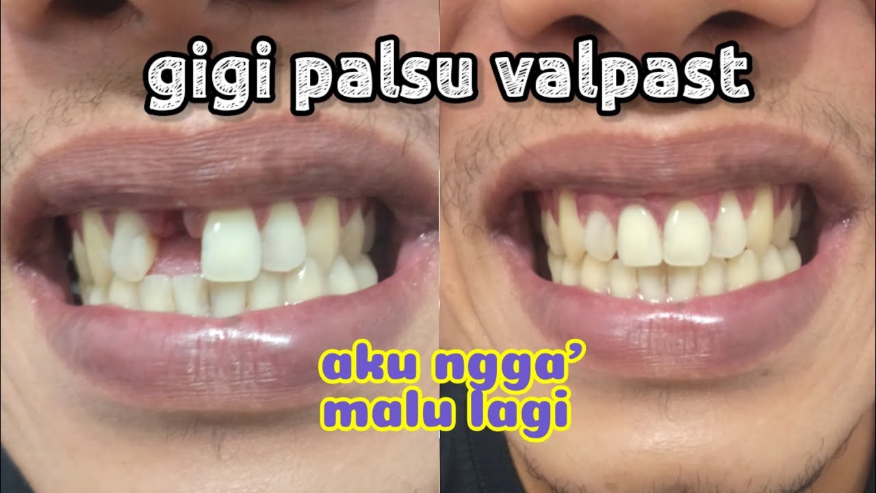 GIGI PALSU VALPLAST - YouTube