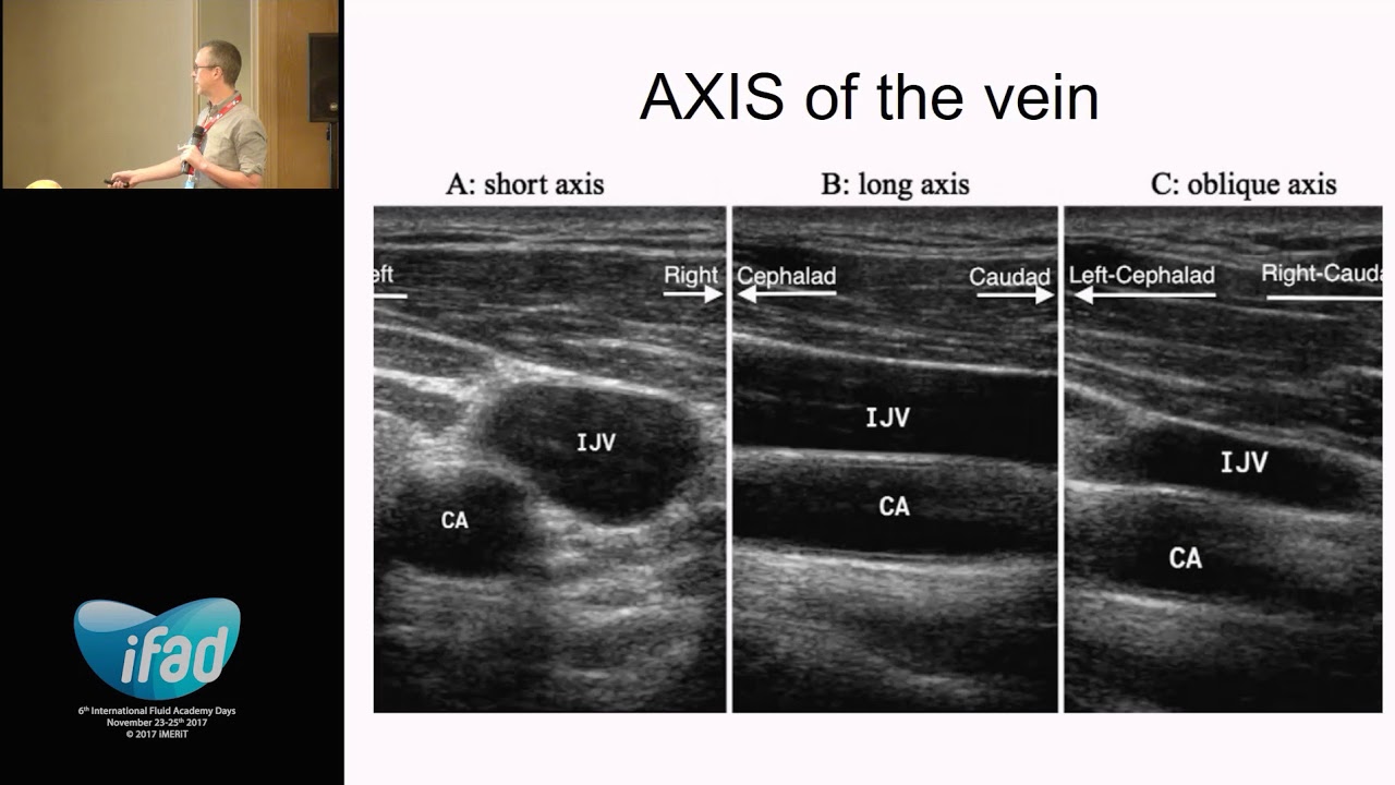 US Vascular access 2017 – Willem Stockman - YouTube