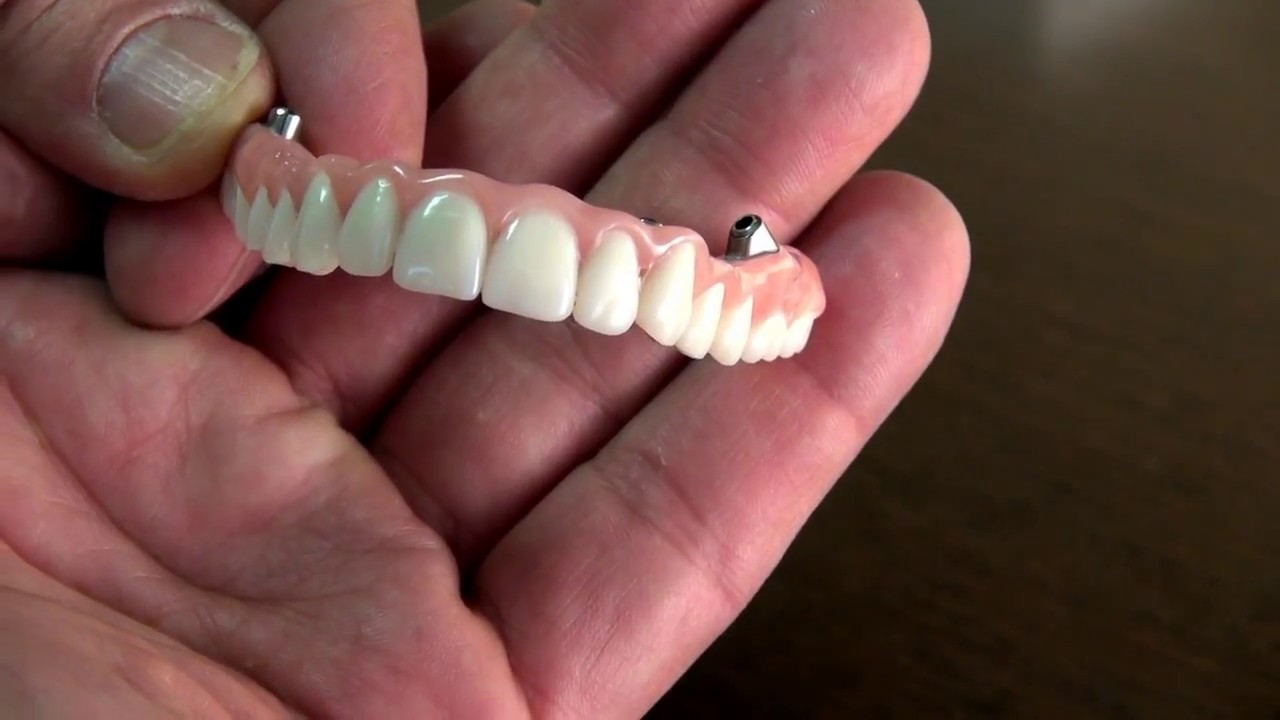 Dental Implants by Dr. Sean Mohtashami of All Bright Dental - YouTube