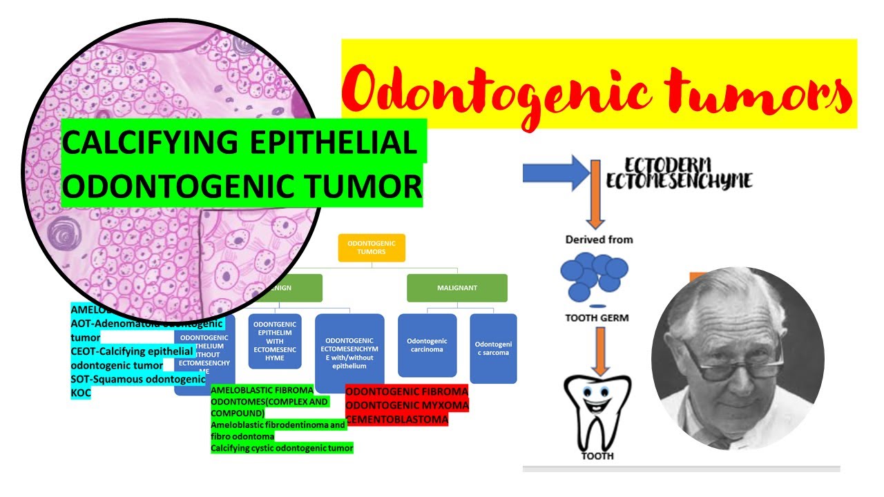 Calcifying epithelial odontogenic tumor (CEOT)DETAILED|Pindborg tumor ...