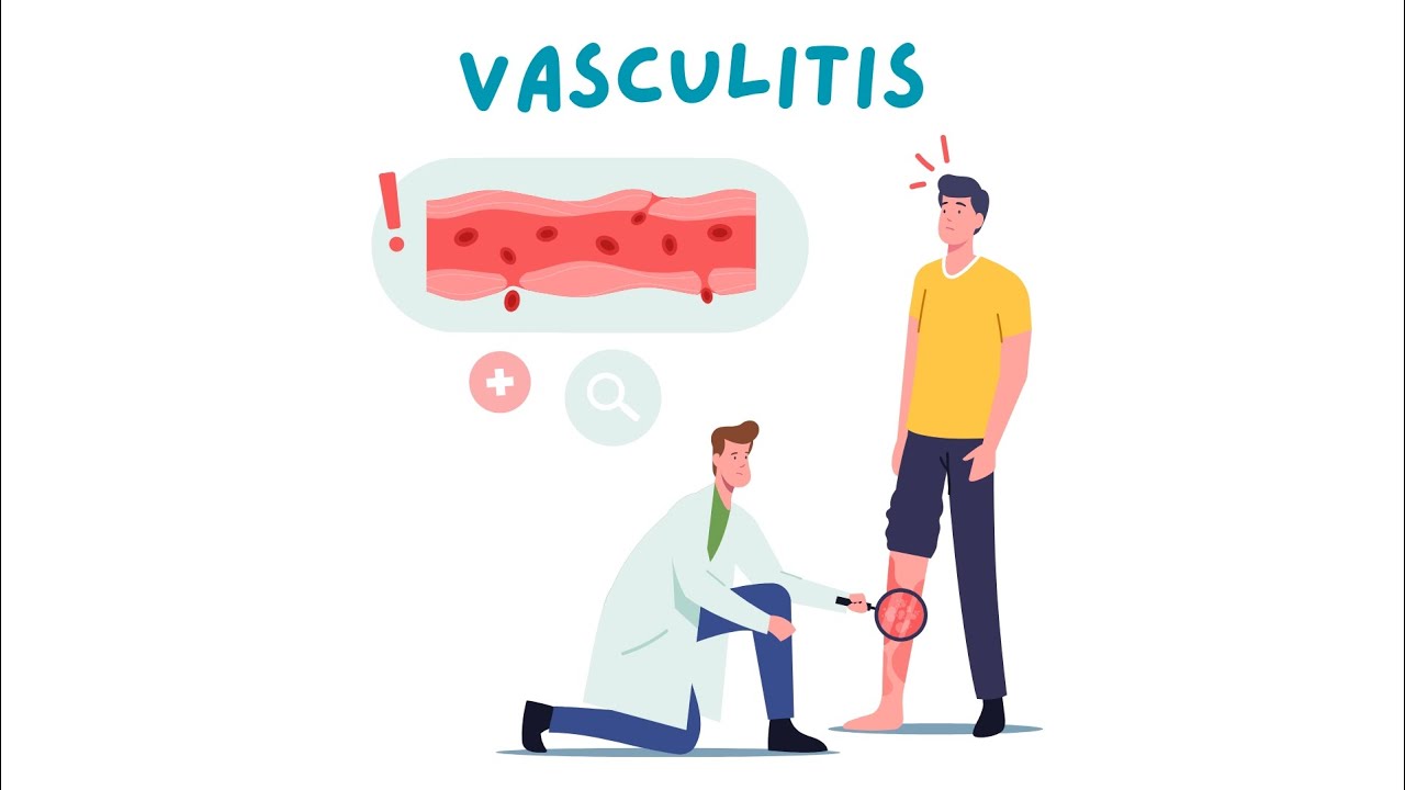 Vasculitis - classification, pathogenesis, clinical picture, diagnosis ...