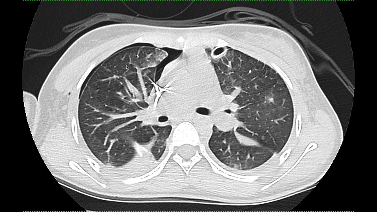Atelectasia, contusão pulmonar ou COVID19??? - YouTube
