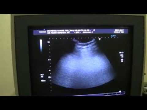 BLEED with CLOT formation LT HEMI SCROTUM post trauma - YouTube