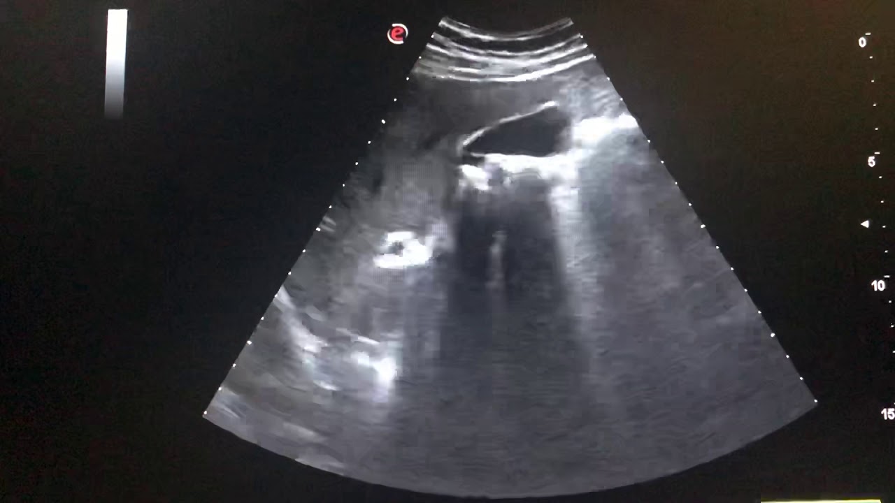 Vesicle ultrasound. Gallstones Ecografia vesícula. Litiasis vesicular ...