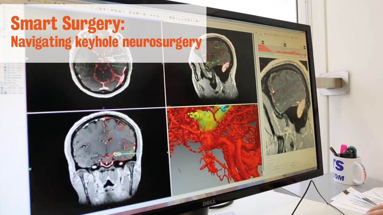 Smart Surgery: Navigating keyhole neurosurgery, quicker and safer - YouTube