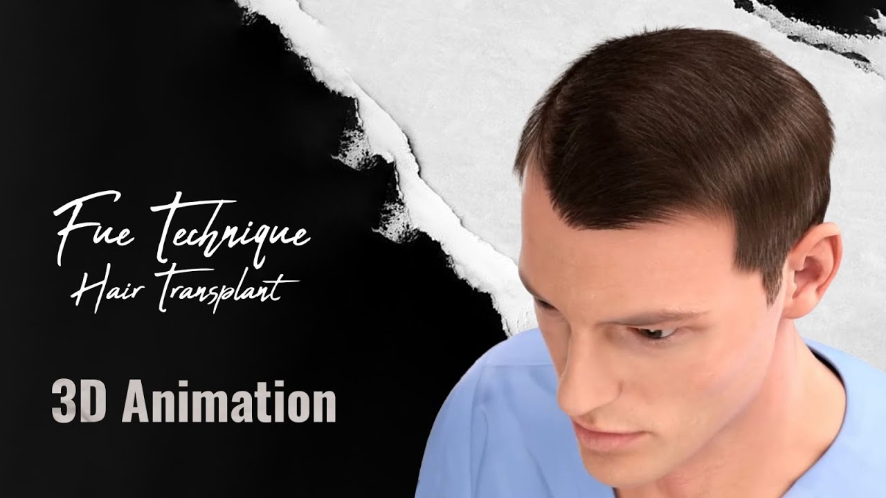 FUE Hair Transplant Animation | How FUE Hair Restoration Works - YouTube