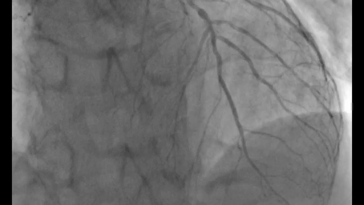 Cardio2012-ECG351-CAG-pre PCI- LCA CRA30° - YouTube