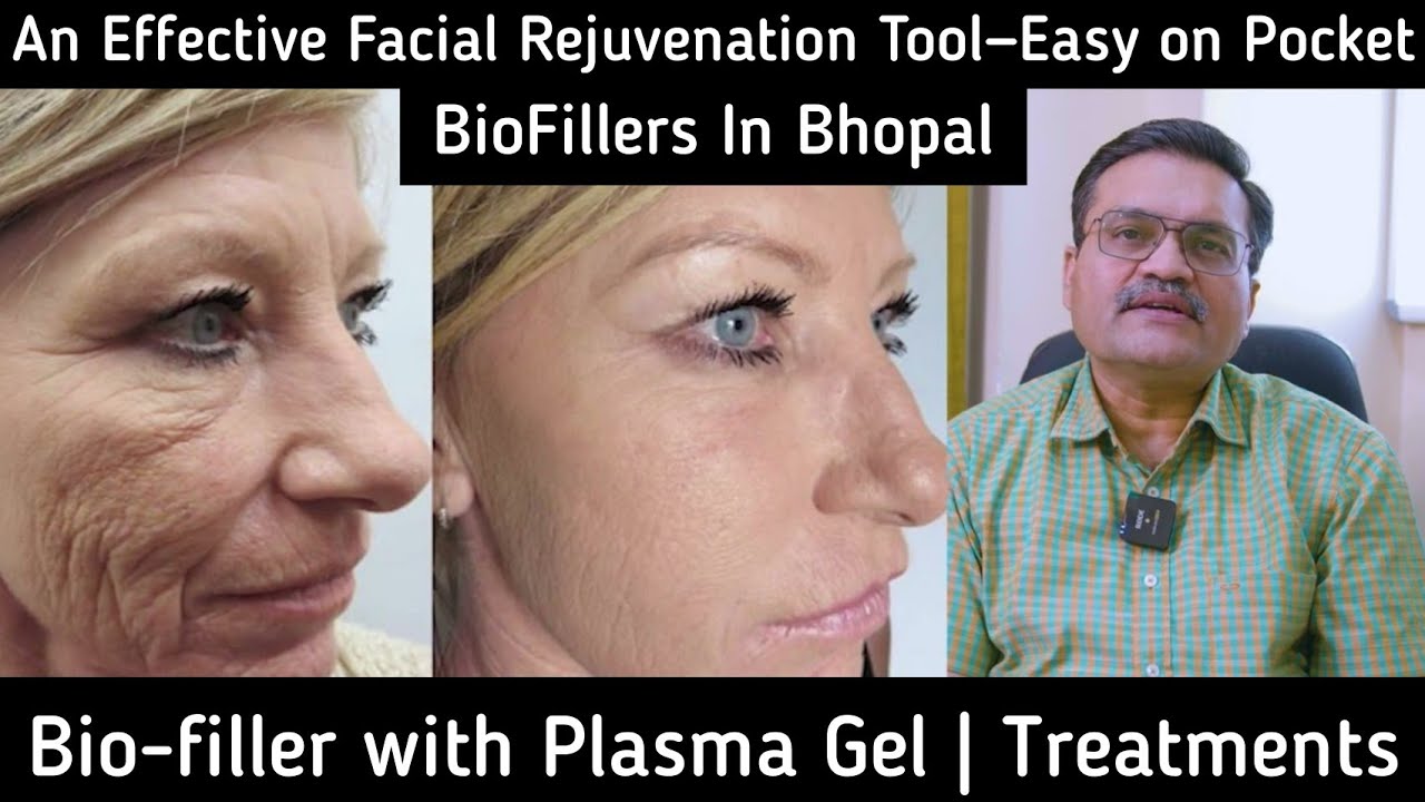 Biofillers in Bhopal | Bio-Filler: An Effective Facial Rejuvenation ...