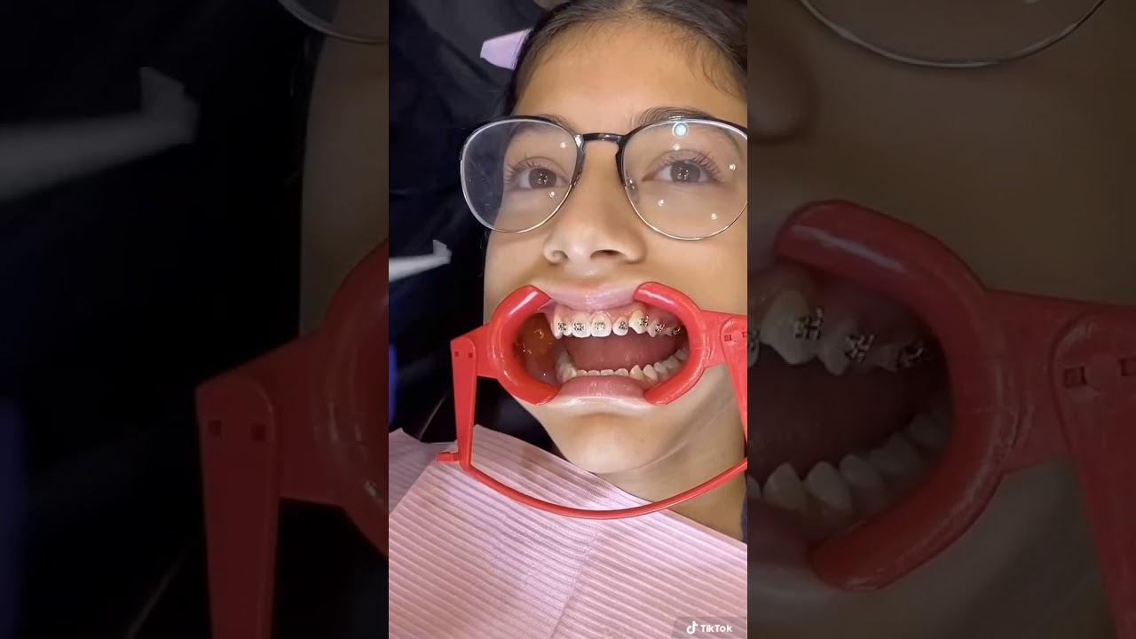 How Braces are Put On | Dr Bar The Braces Doc - YouTube