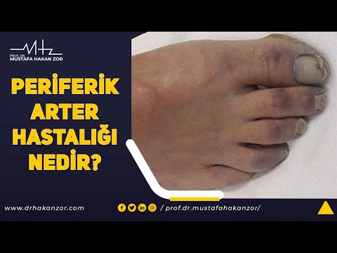 Periferik Arter Hastalığı Nedir? Periferik Arter Hastalığı Belirtileri Nelerdir?