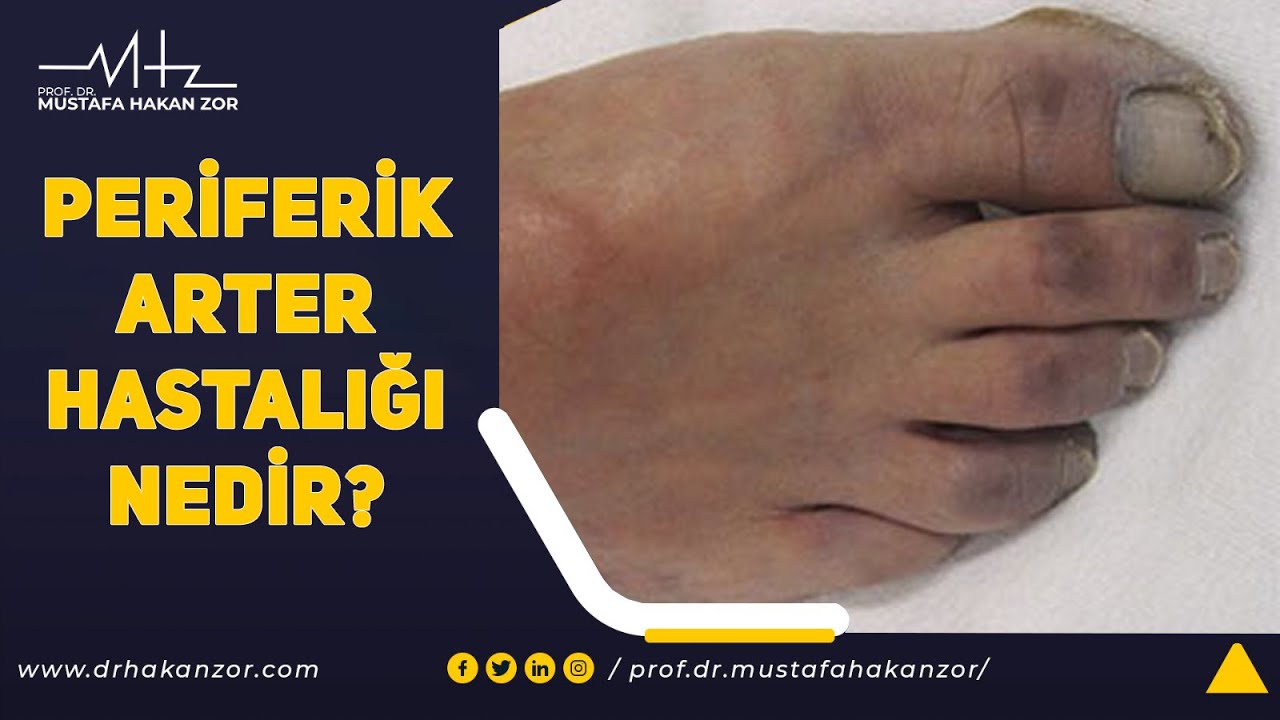 Periferik Arter Hastalığı Nedir? Periferik Arter Hastalığı Belirtileri ...