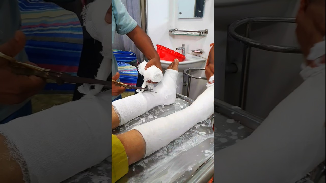 Both short leg full plaster #ourtreatment #footfracture #foot # ...