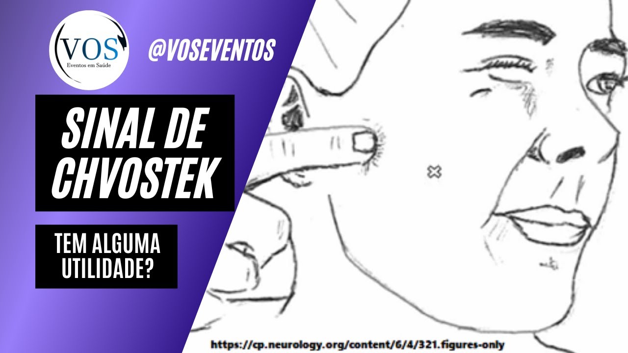Sinal De Chvostek Possui Alguma Utilidade Clinica Youtube