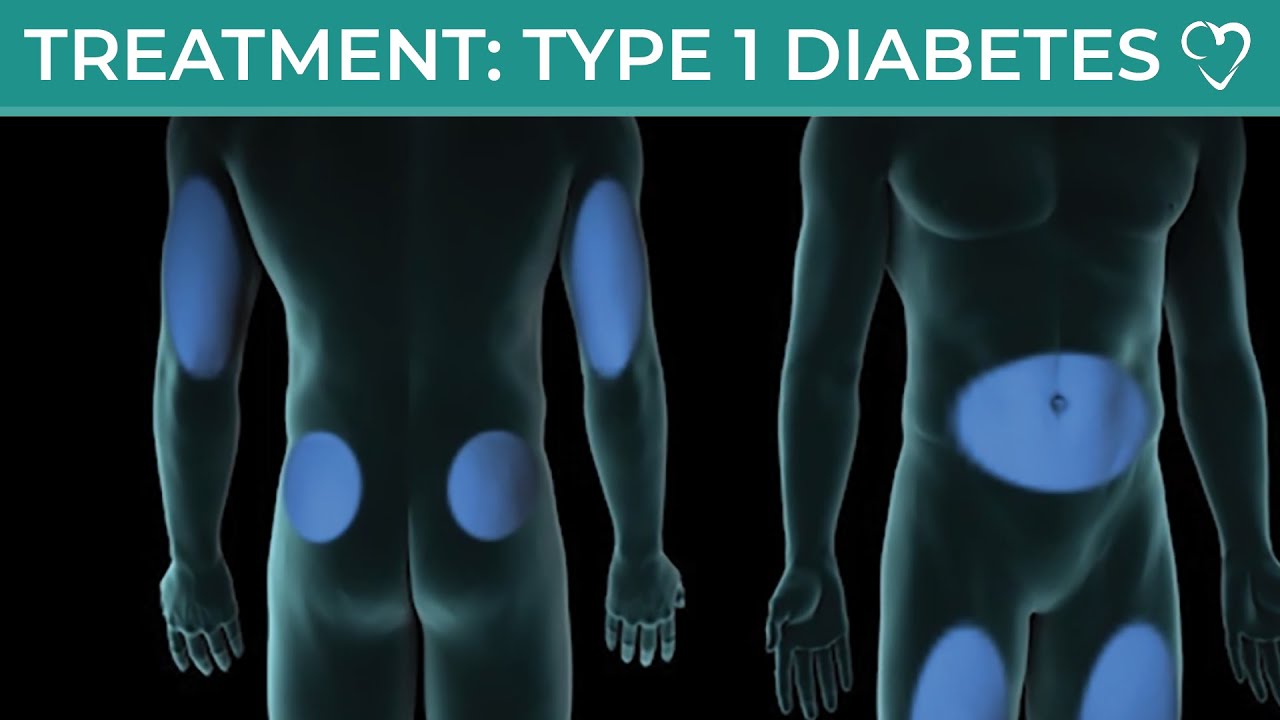 Understanding Type 1 Diabetes: Treatment - YouTube