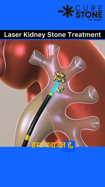 Laser kidney stone treatment | Retrograde Intrarenal Surgery | Rirs | Kidney Stone Treatment # ...