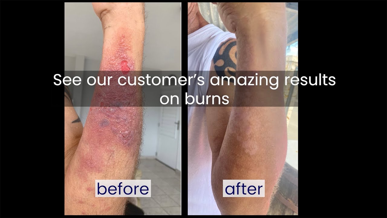 Discover Healing Power: TriDerma Intense Fast Skin Healing Cream | Your ...