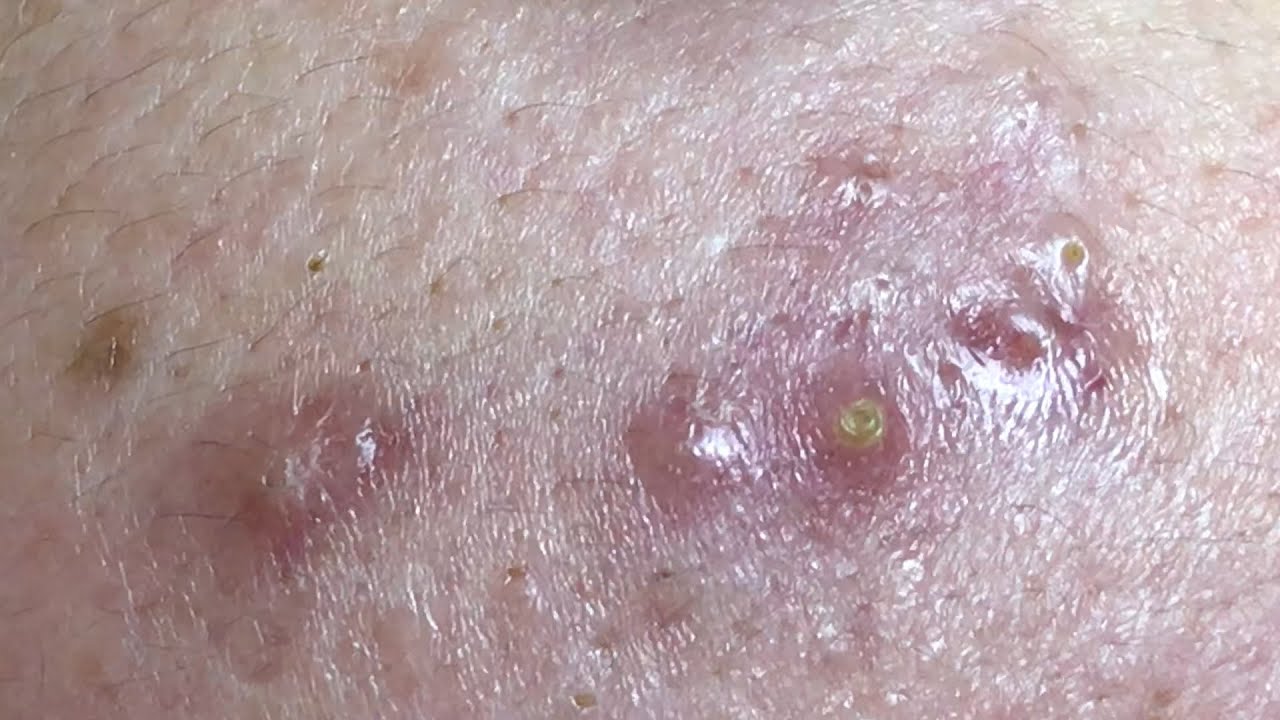 MILIA UNDER EYES and INFLAMED ACNE EXTRACION | Suri Job 120 - YouTube
