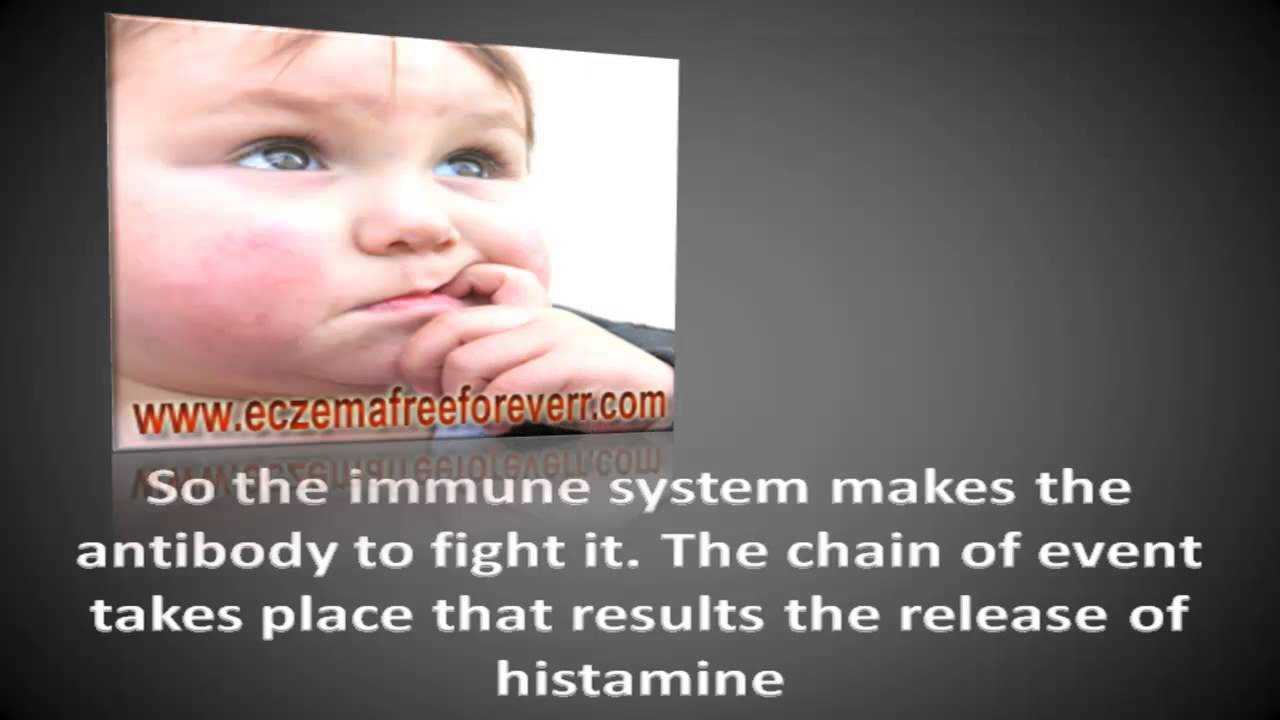 Contact Dermatitis treatment In Home - YouTube
