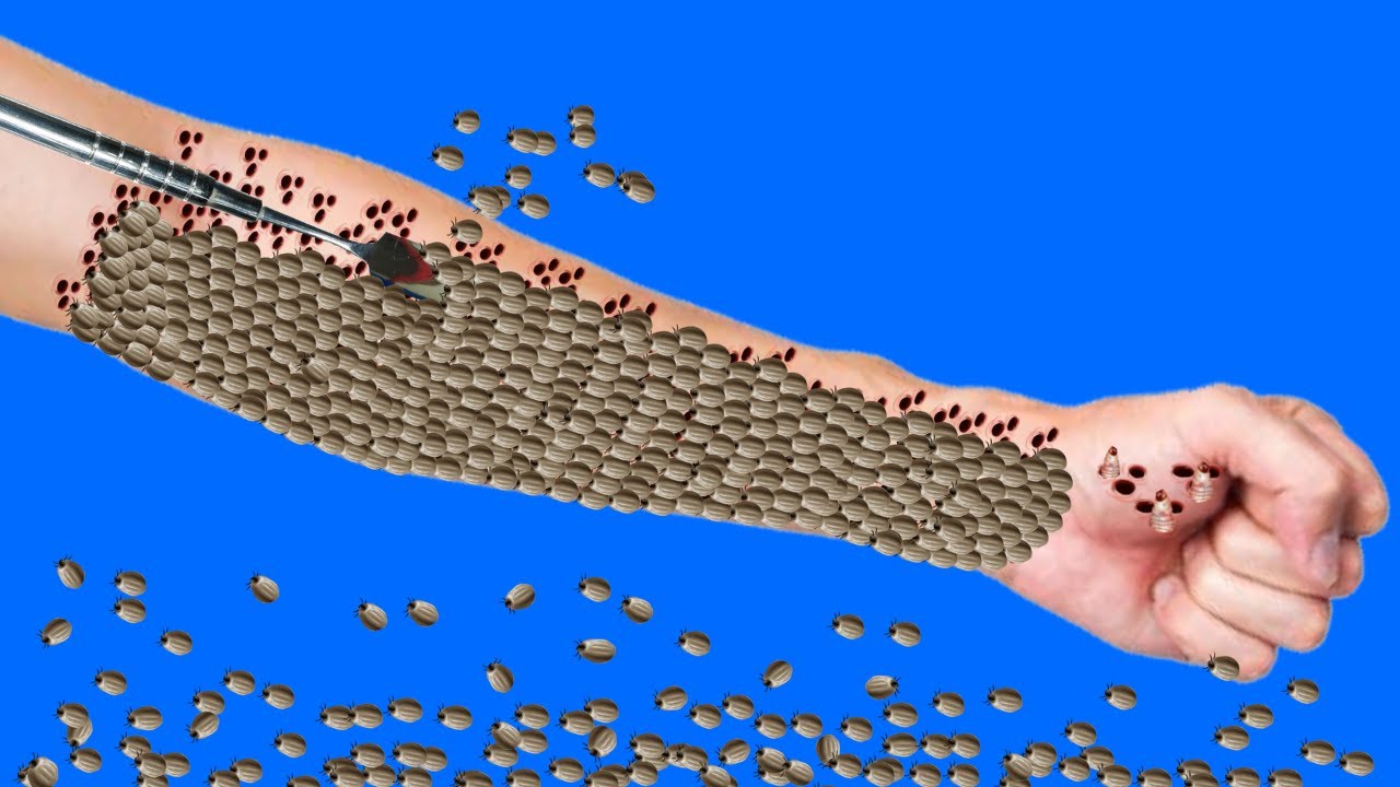 ASMR Treatment 2D Animation | Dog Ticks Infected Hand | @HealAsmr914K ...