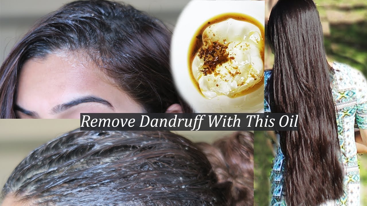 Best Home Remedy To Remove Dandruff | How to Get Rid of Dandruff at ...