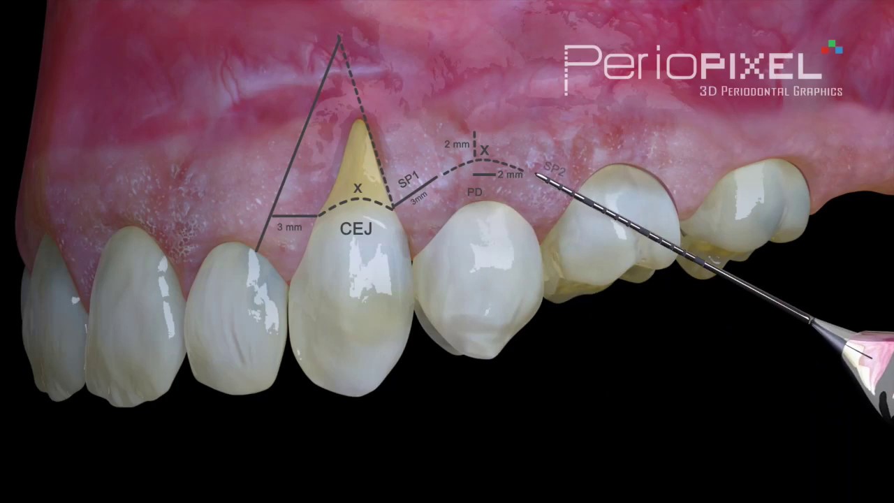 3D dental video - Laterally Moved and Coronally Advanced Flap ...