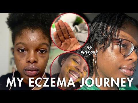 HOW I HEALED MY ECZEMA | My Eczema Journey to Clear Skin + How to Treat ...
