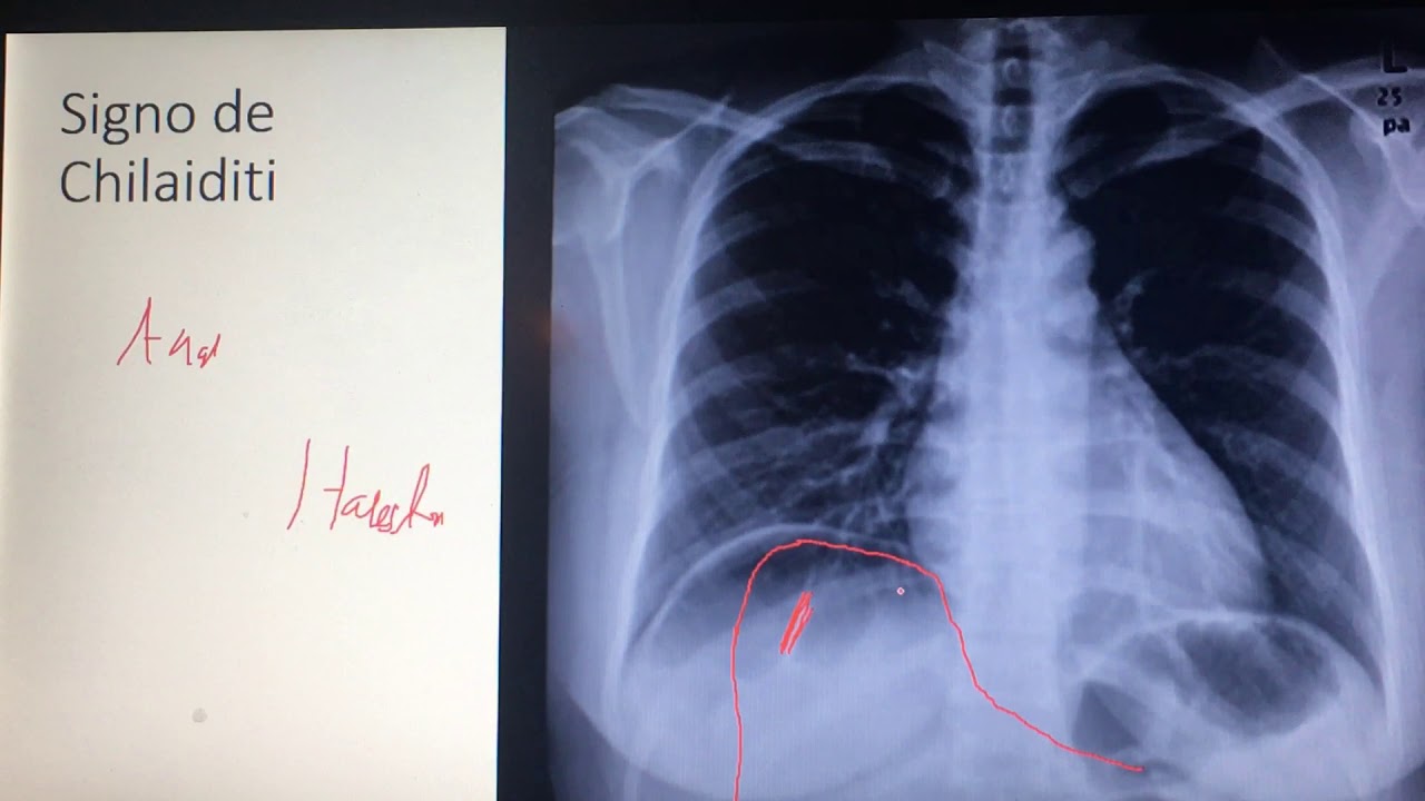 Lección 25. Signo de Chilaiditi. Radiografía Torax - YouTube