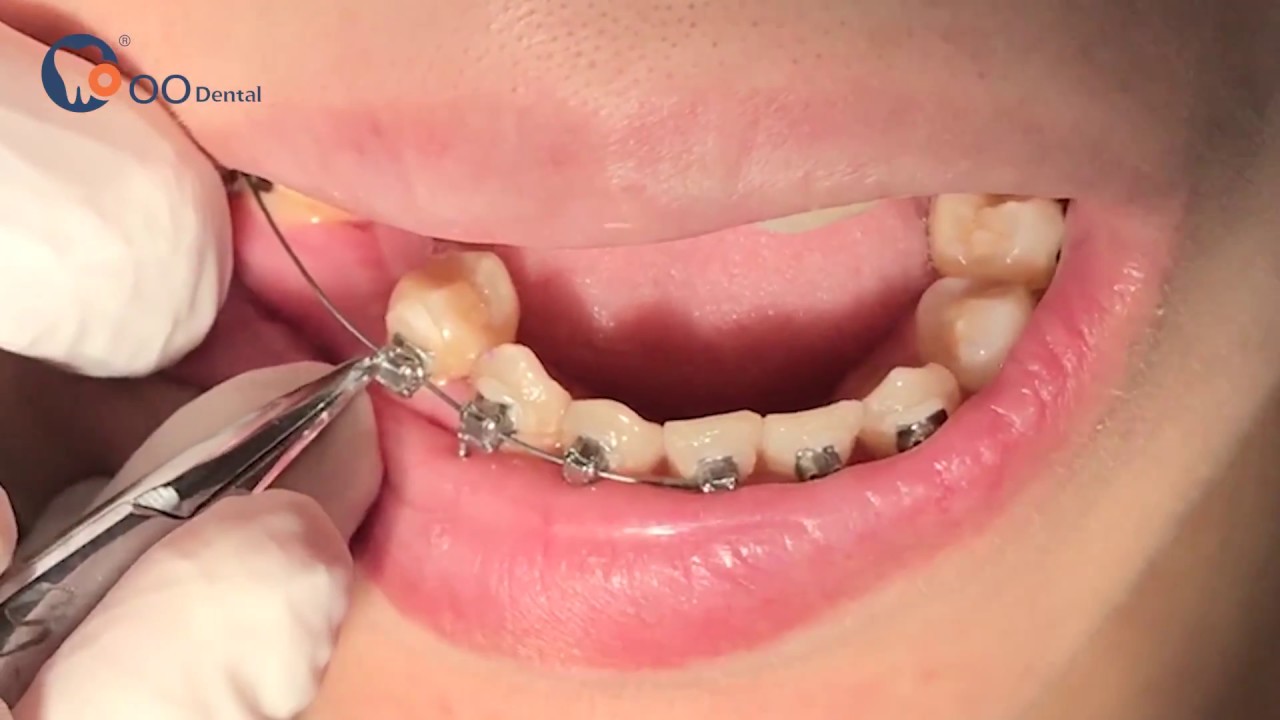 OO Dental | Ligation with O-EYES Bracket - YouTube