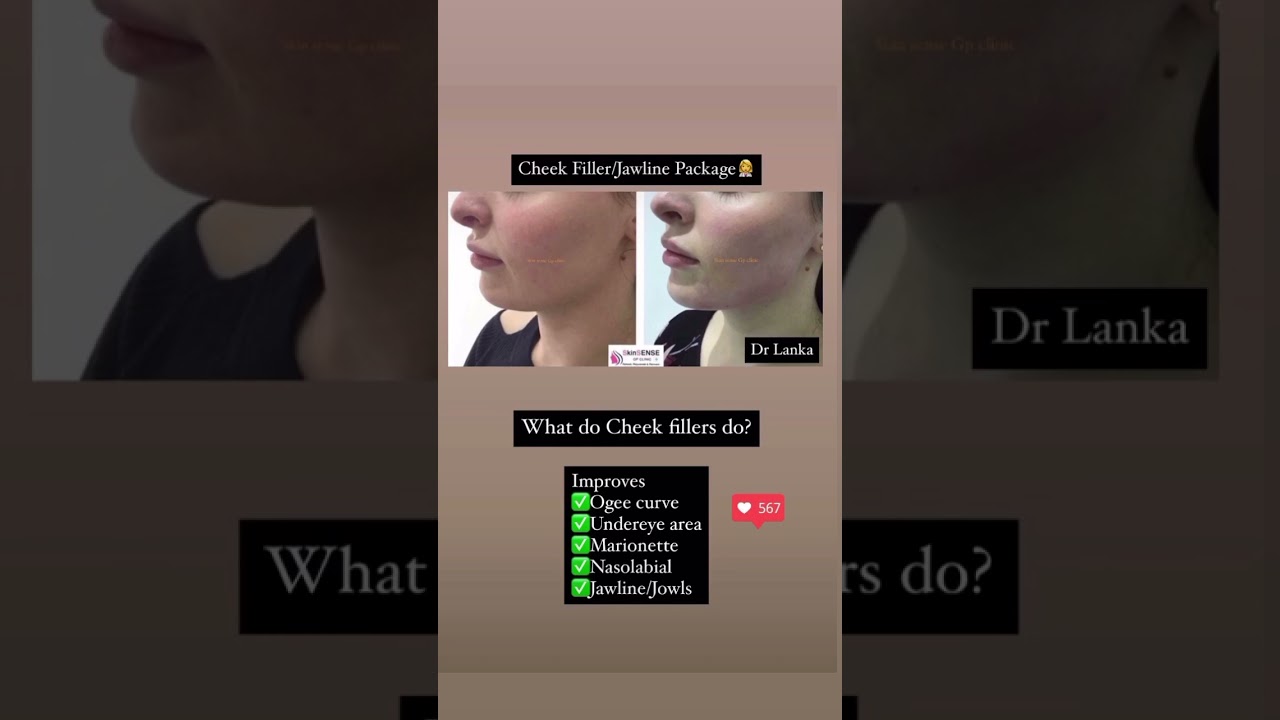 Cheek Fillers/Ogee curve/mid facelift Restore the curve of youth ...