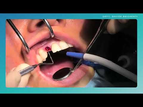 Estrazione dente devitalizzato,impianto immediato - Devitalized tooth ...