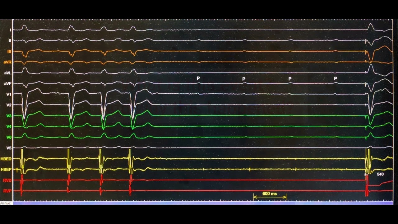 Complete heart block (CHB) ll Event while positioning His bundle ...