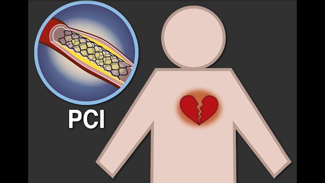 The COURAGE Trial - YouTube