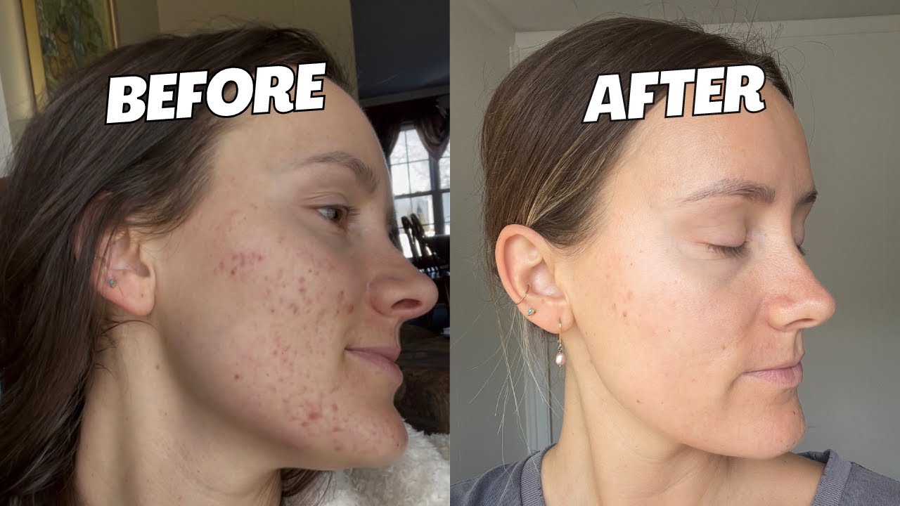 3 things that healed my acne NATURALLY & QUICKLY after 3.5 years of ...