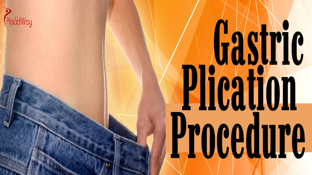 Gastric Plication Overview - Great Weight Loss Surgery Option - YouTube