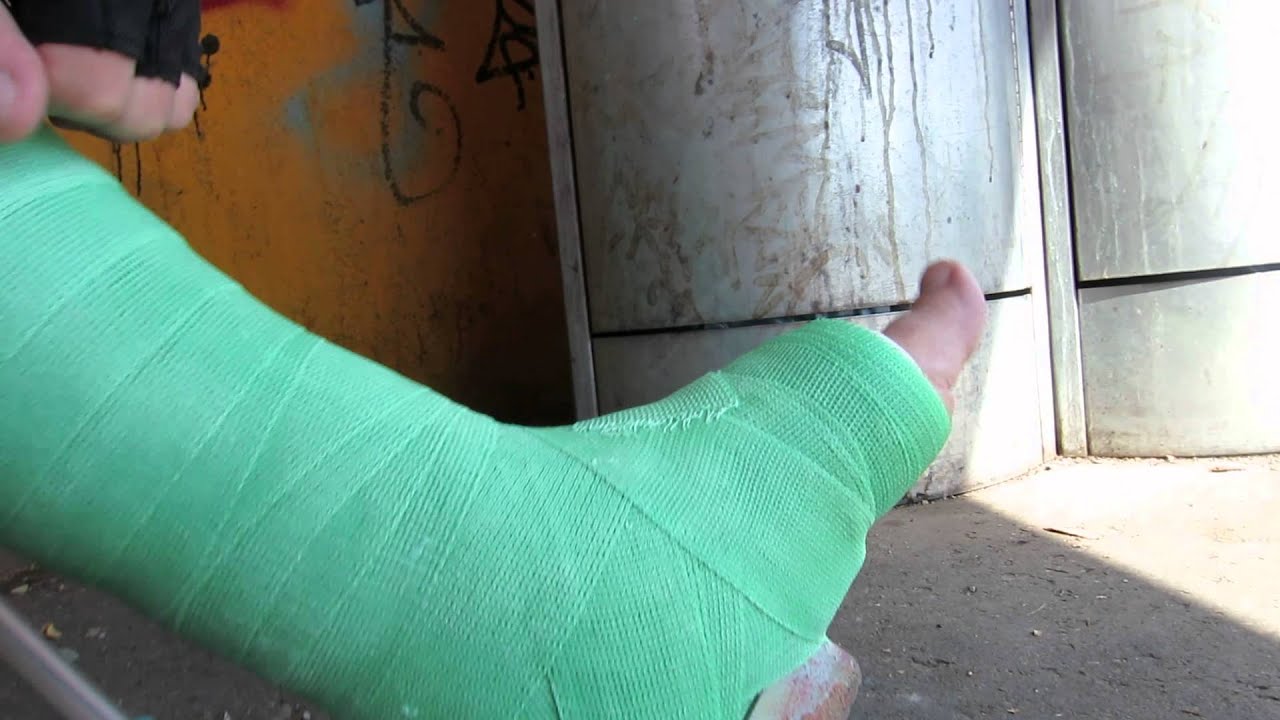 Mit grünem Gipsbein in Berlin unterwegs (Teil 3) - YouTube