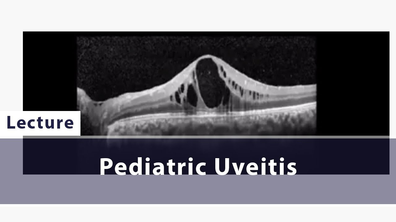 Pediatric Uveitis - YouTube