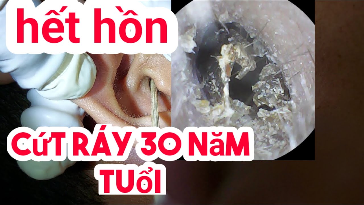 30 tuổi mới lấy ráy tai kết quả khủng khiếp / 30 year old wax - YouTube