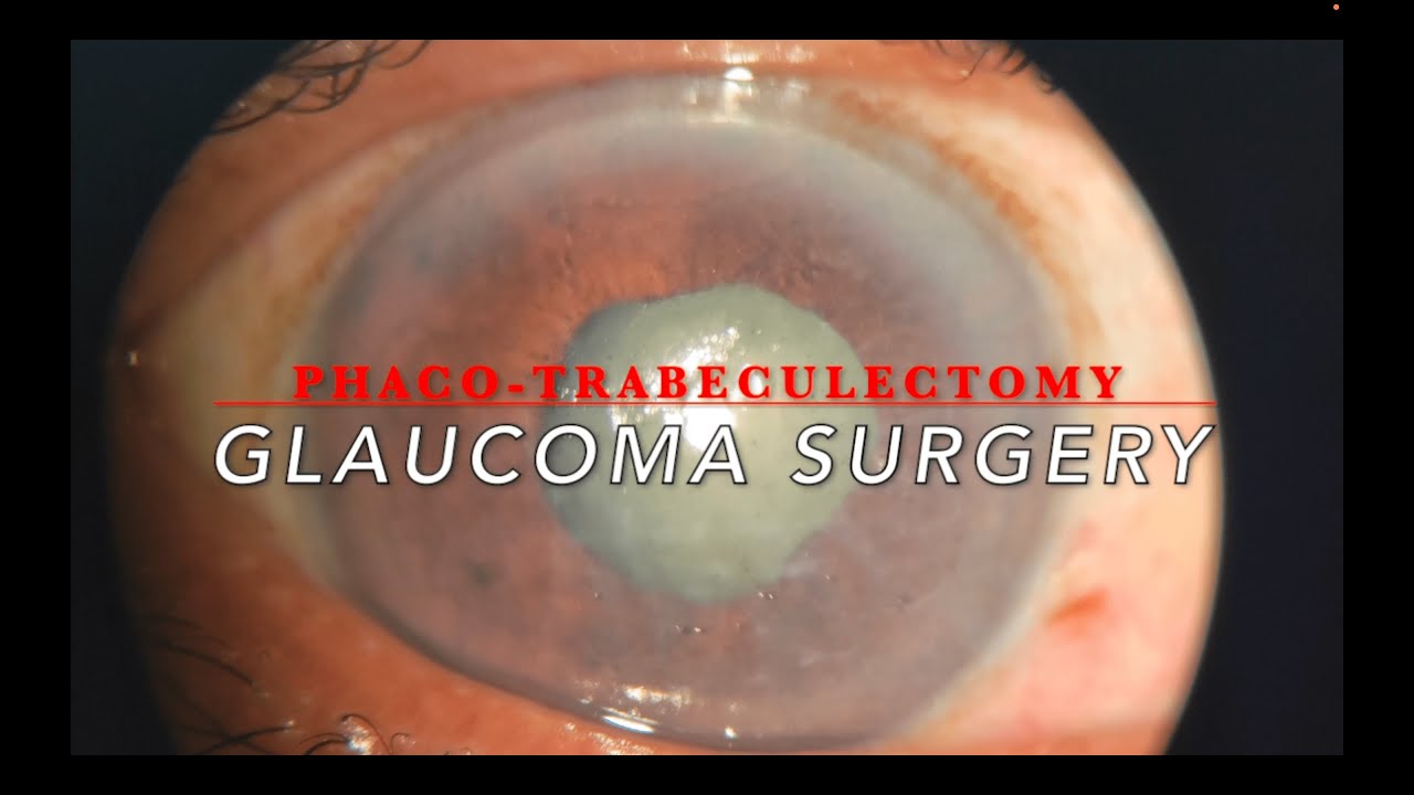 MIIQ 11: Phaco-Trabeculectomy: Combined Glaucoma and Cataract Surgery || DR. MD IFTEKHER IQBAL ...