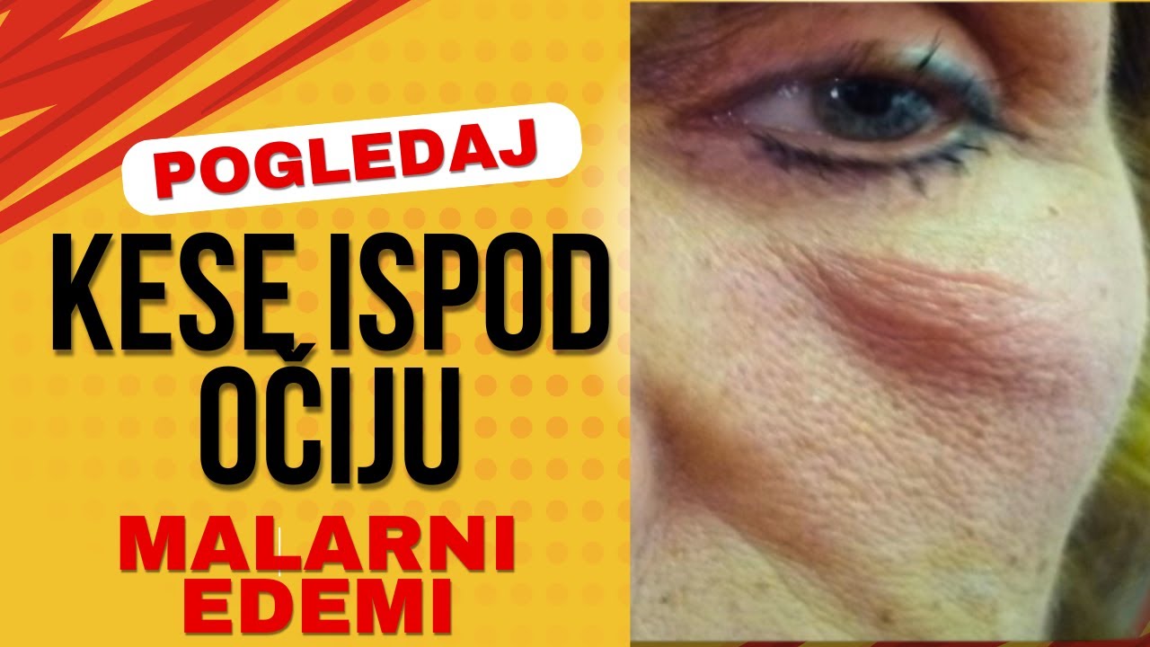 Kese ispod očiju: Malarni Edemi: Razlozi Nastanka i Metodi Lečenja ...