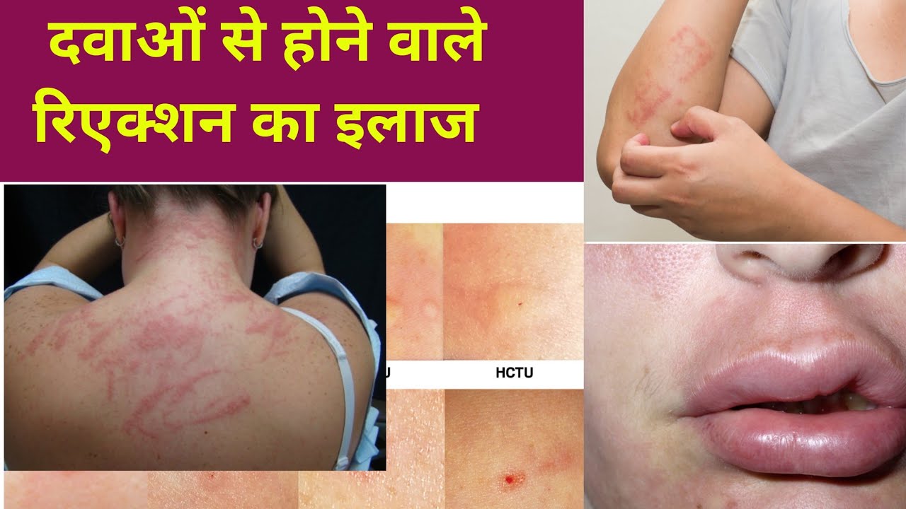 Injection Reaction | Medicine Reaction | Reaction Treatment | Treatment ...