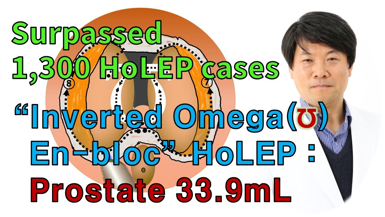 Surpassed 1,300 HoLEP Cases. Inverted Omega En-bloc HoLEP technique ...