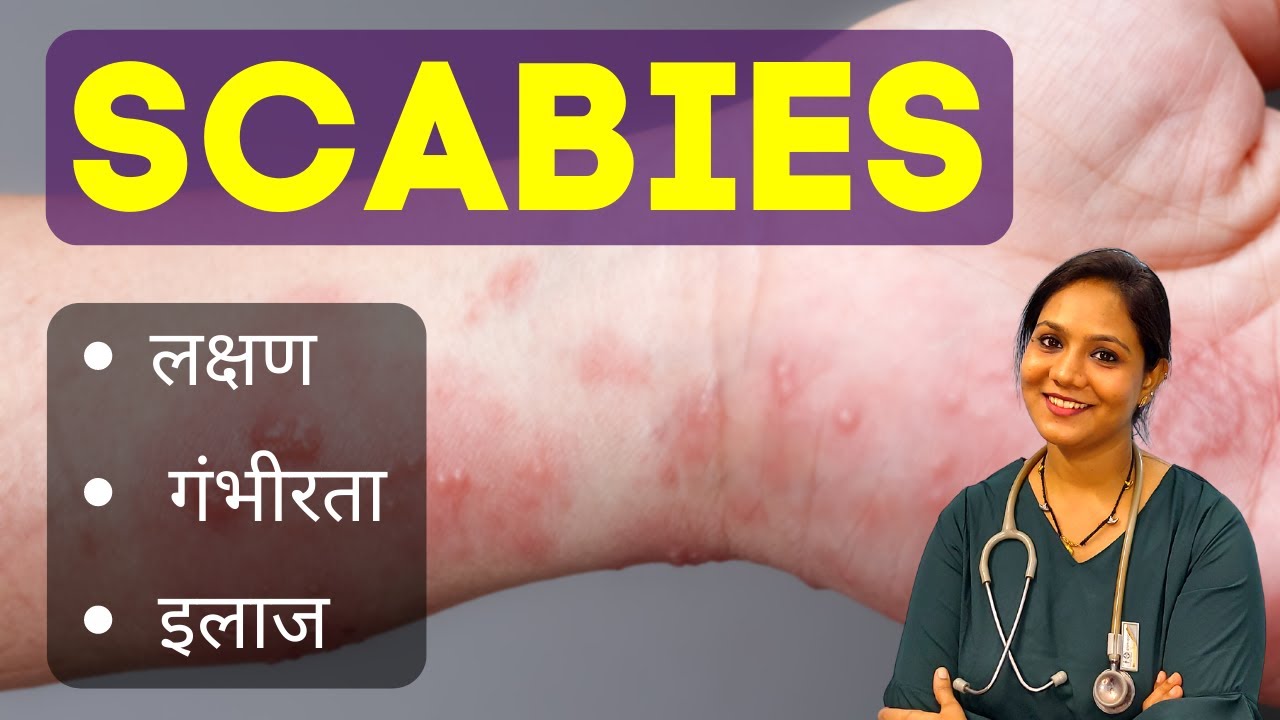 Scabies क्यों होता हैं? | Scabies Symptoms, Reasons & Treatment - YouTube