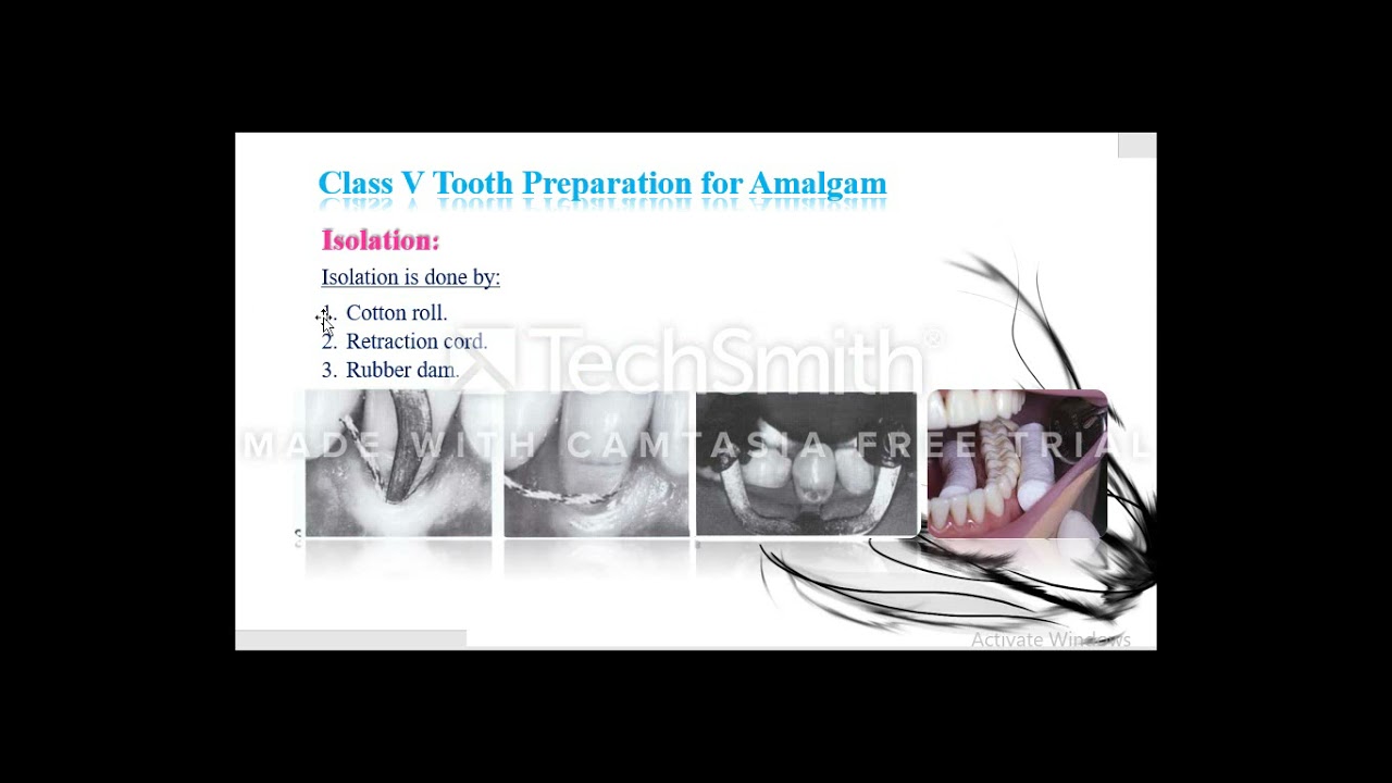 class V tooth preparation for amalgam - YouTube
