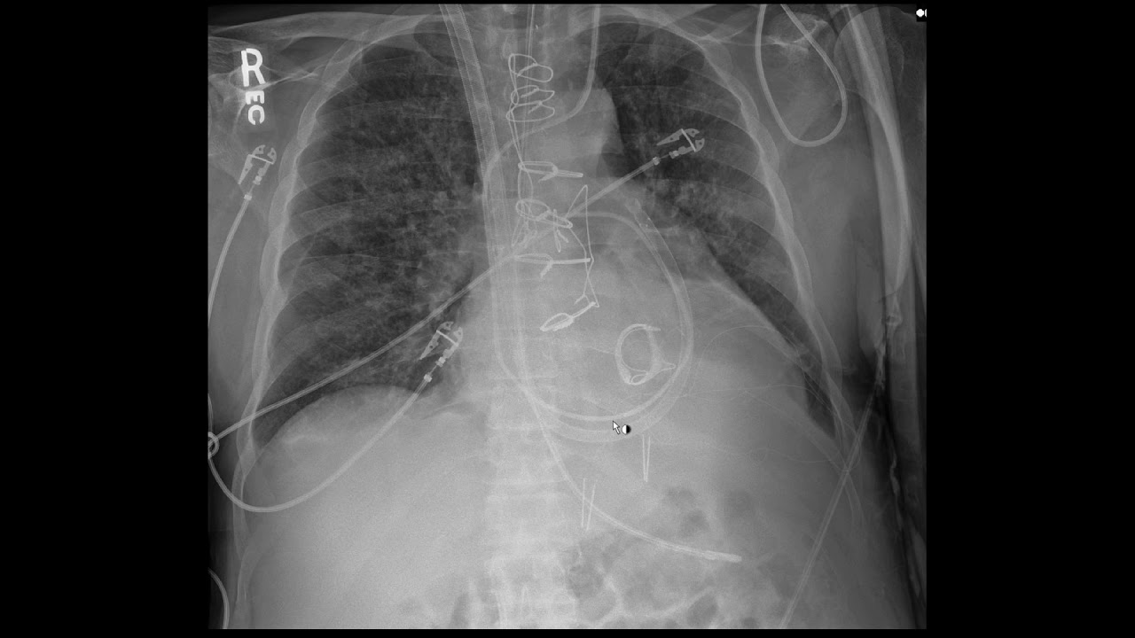 Imaging of Cardiac Support Devices - YouTube