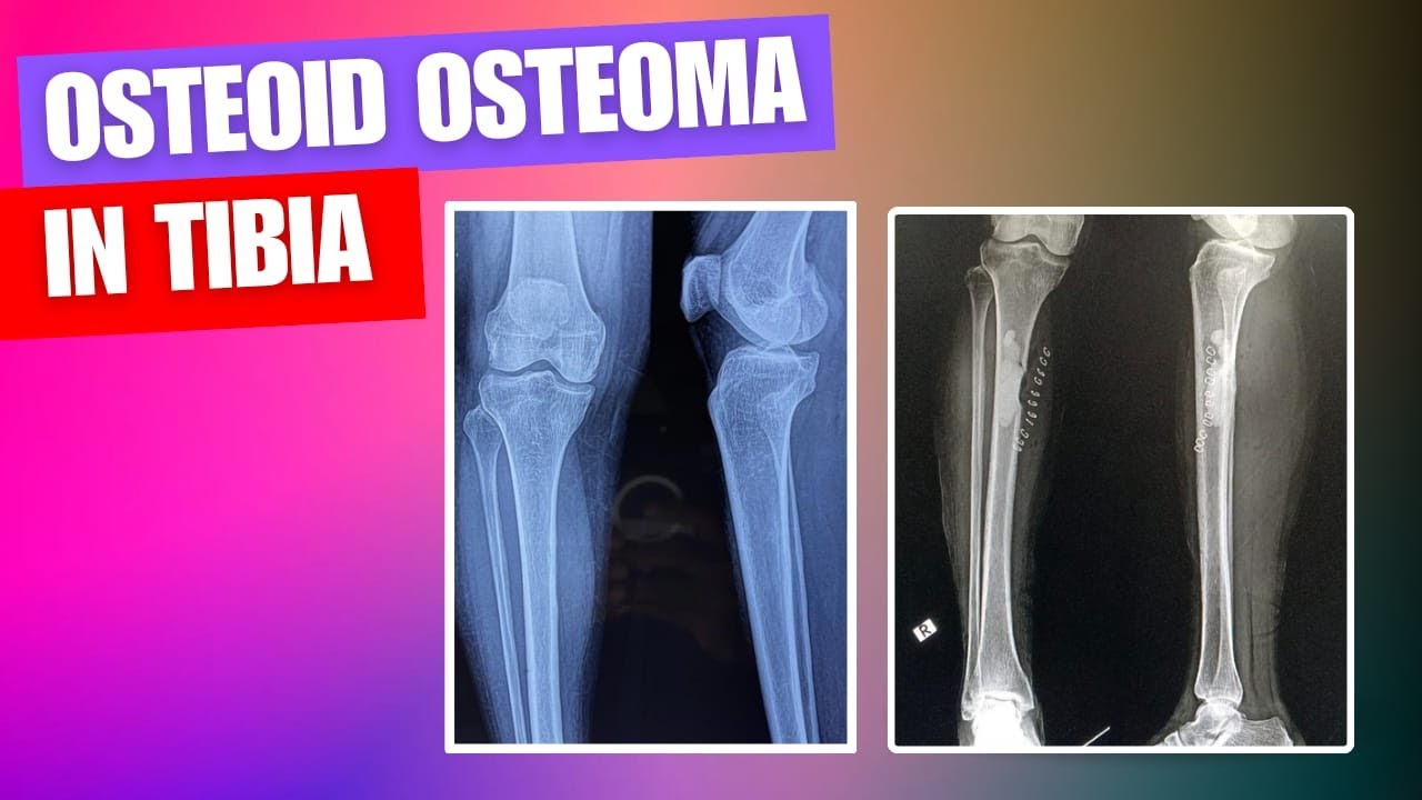 EXCISION OF OSTEOID OSTEOMA FROM TIBIA IN A MIDDLE AGED FEMALE WITH ...