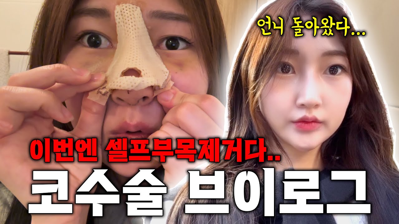코수술 브이로그💟코성형 브이로그 이번엔 셀프부목제거 영상💟 코수술 6일~14일 무보형물 코성형 매부리코 코성형 붓기변화