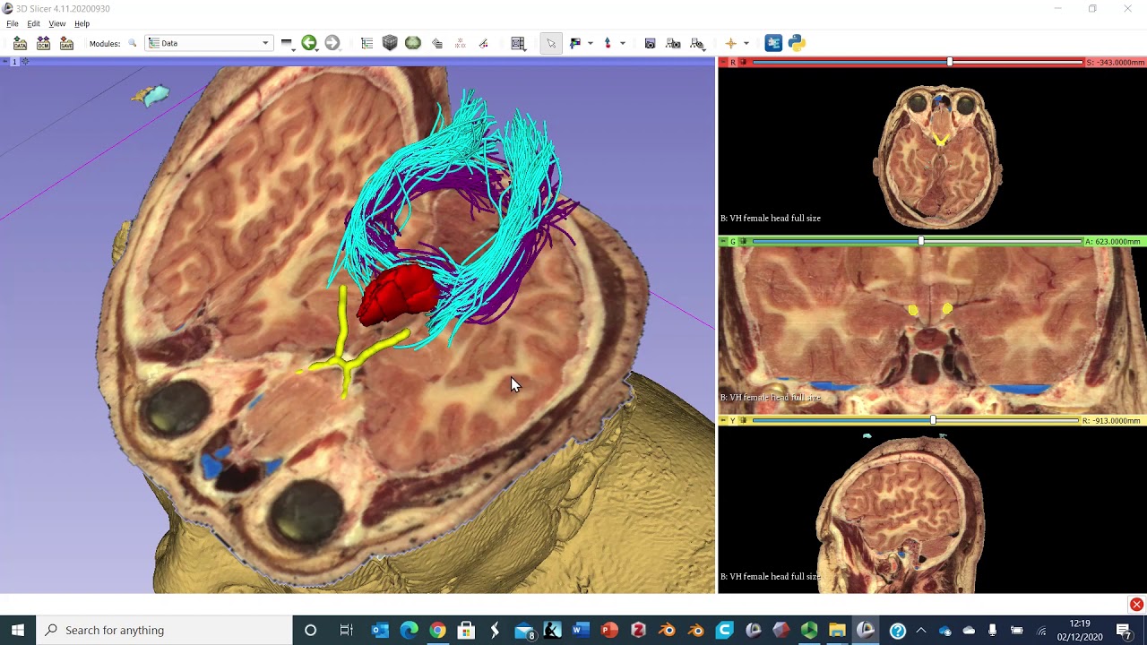 The visual system using data from the Visible Human Project and ...