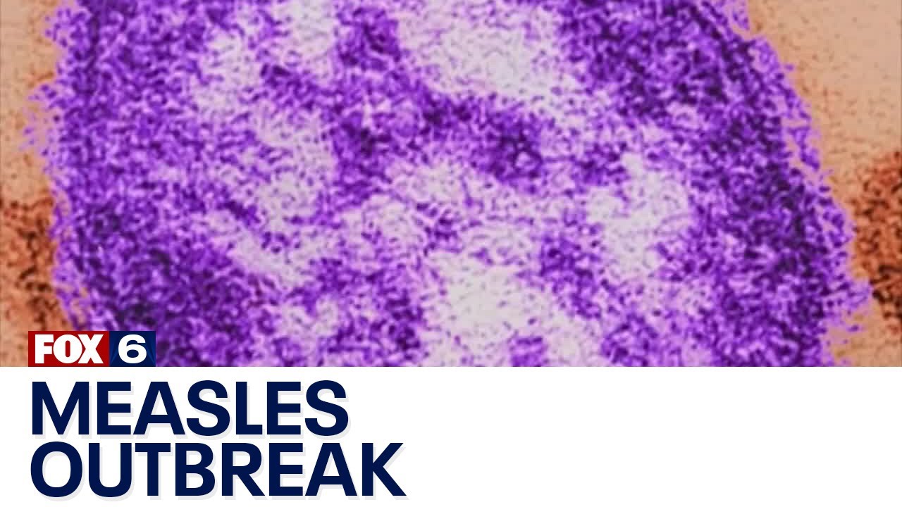 Wisconsin monitors measles cases amid outbreak | FOX6 News Milwaukee ...