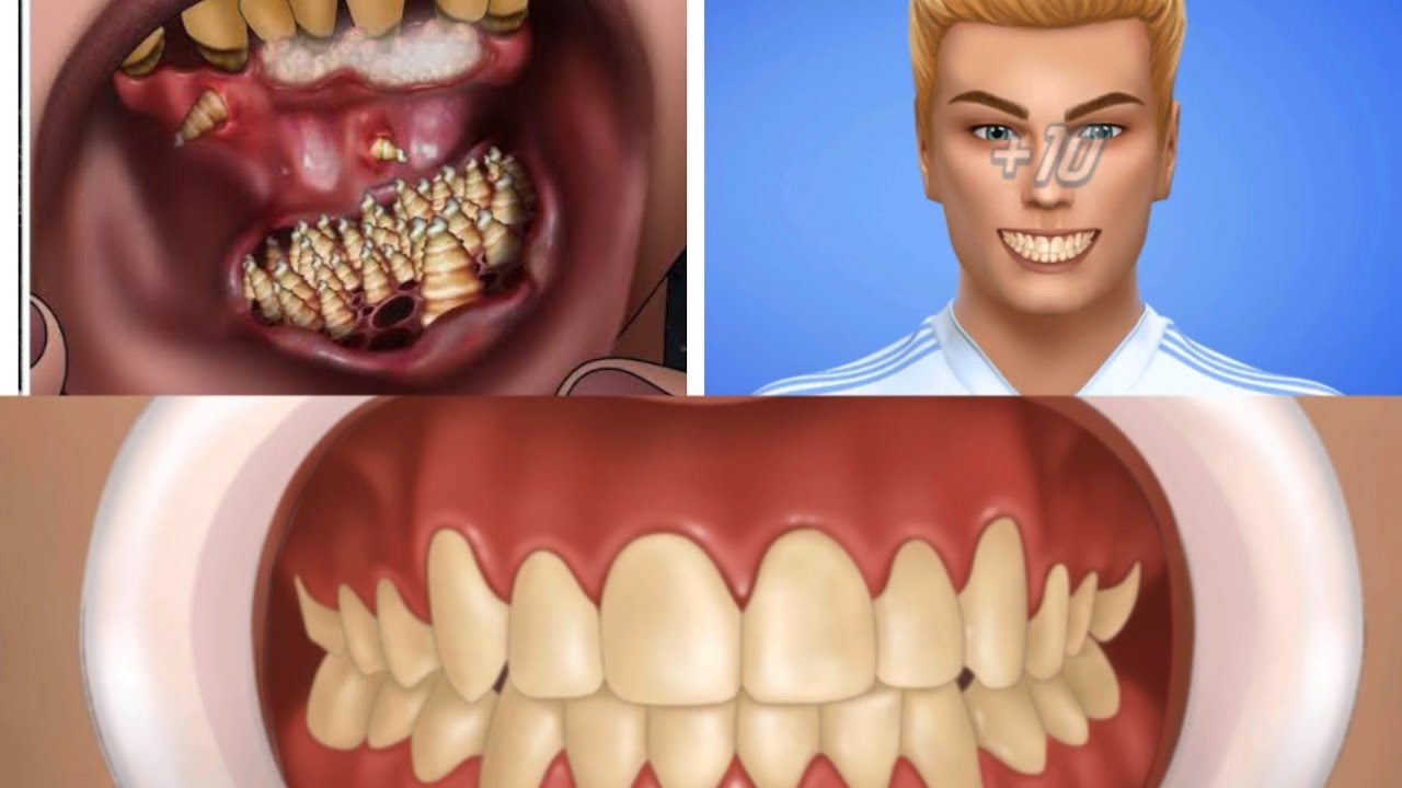 ASMR - Remove Cavity Teeth - Deep Cleaning Asmr - YouTube