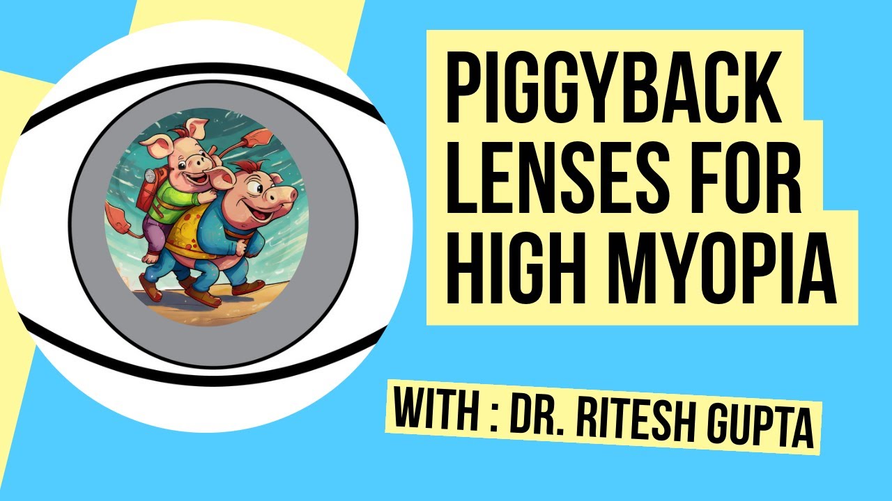 Piggyback Lenses for High Myopia - YouTube